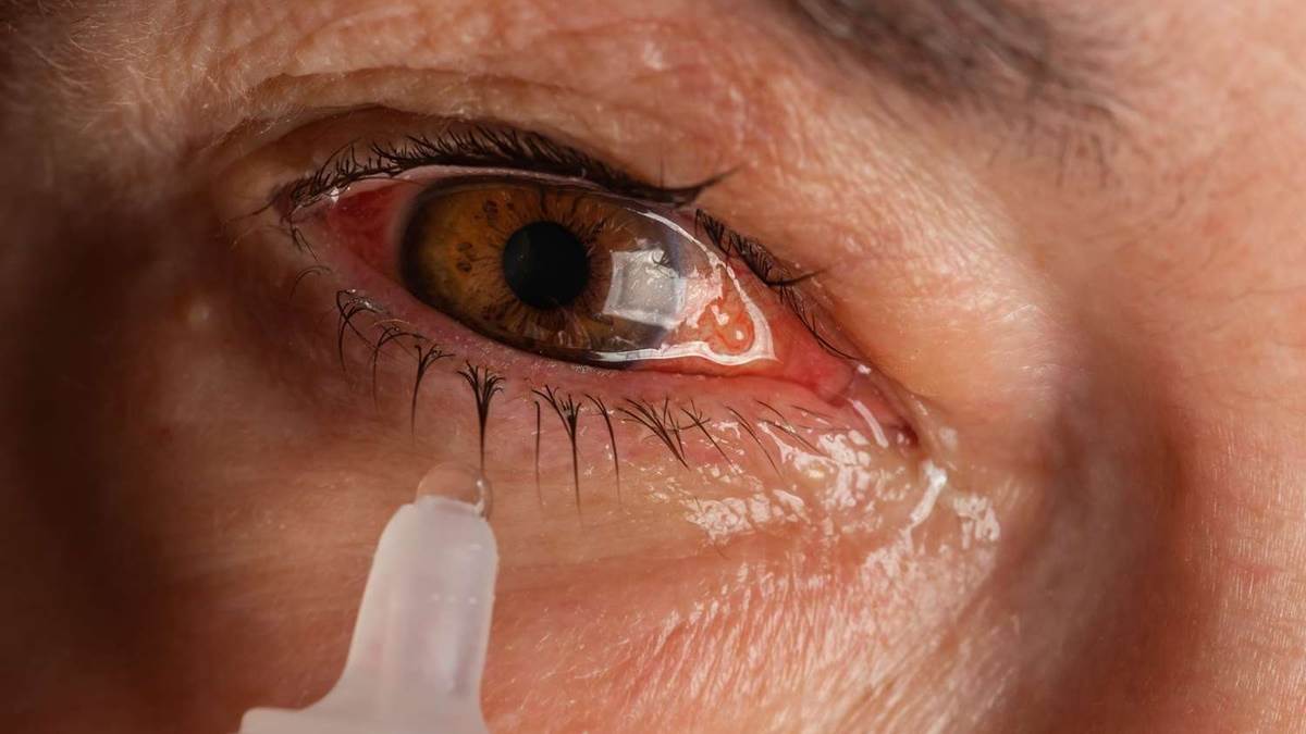 Prevent pink eye by observing these simple precautions | Tehelka